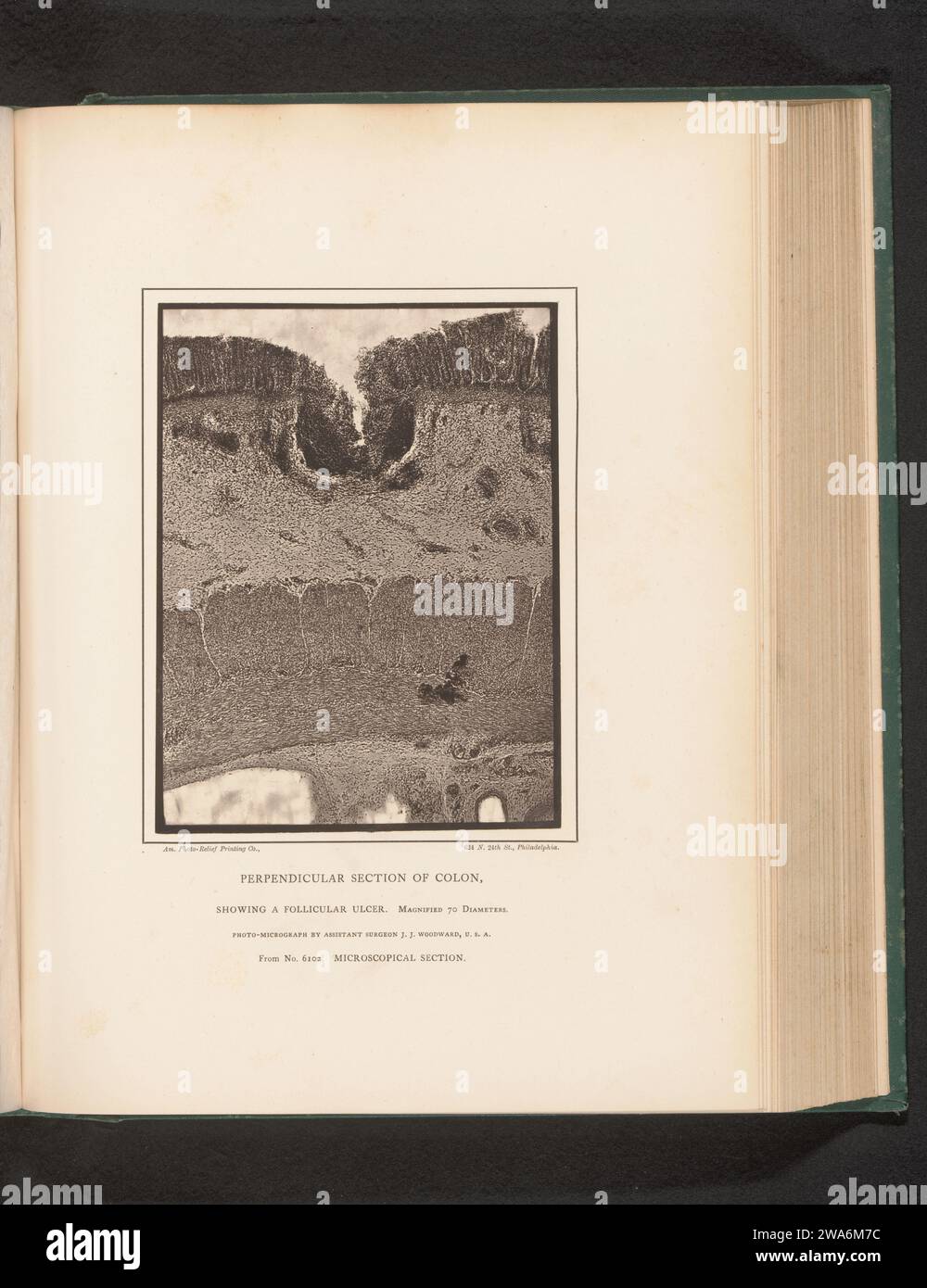 Increasing a swollen cavity in a piece of colon, Joseph Janvier ...