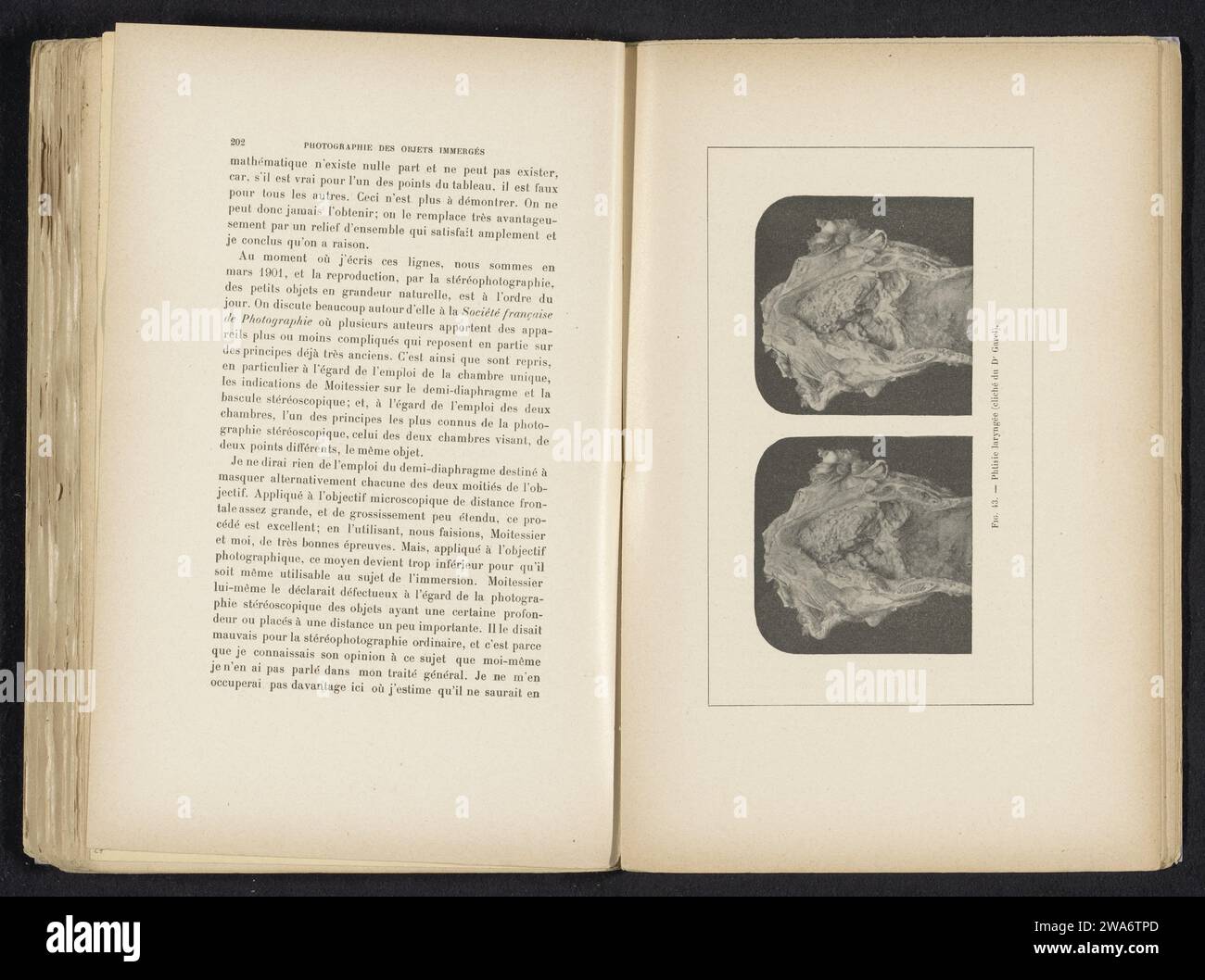 Tuberculosis 1901 hi-res stock photography and images - Alamy