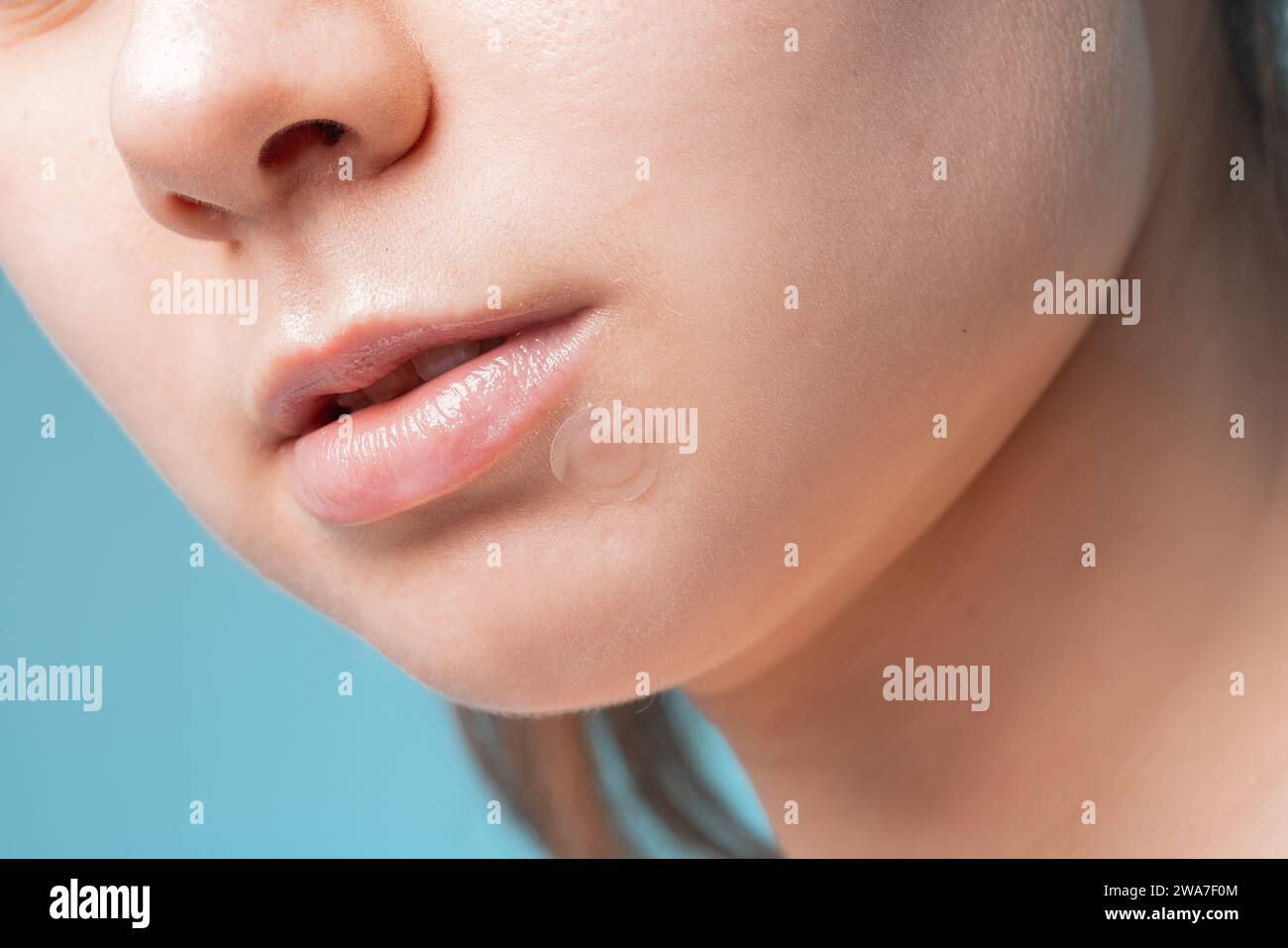 Girl with acne stick round acne patch on her cheek. Using acne patches ...