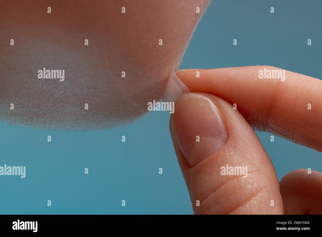 Girl with acne stick round acne patch on her cheek. Using acne patches ...