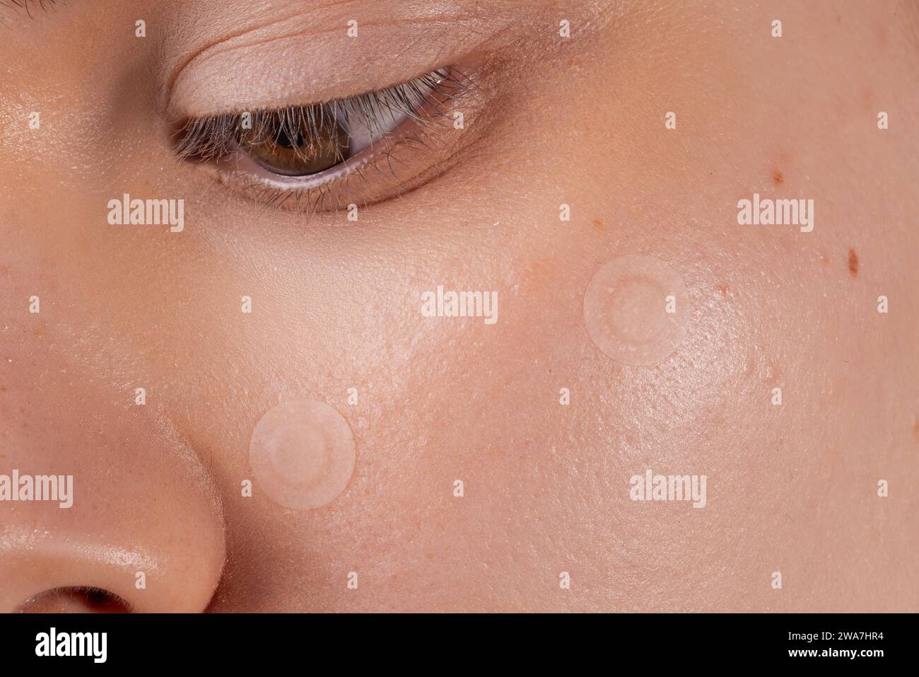 Girl with acne stick round acne patch on her cheek. Using acne patches ...