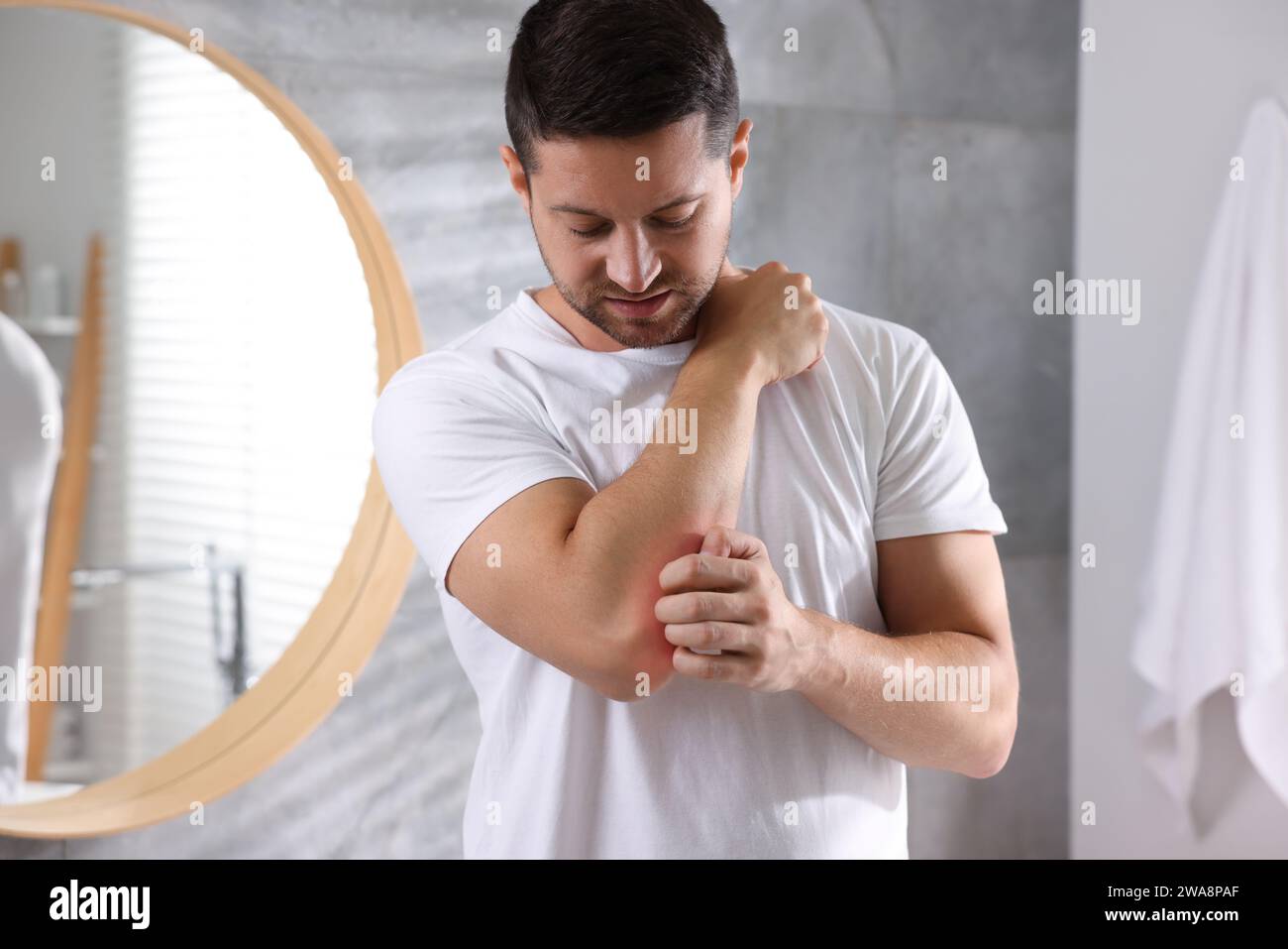 Man scratching arm hi-res stock photography and images - Alamy