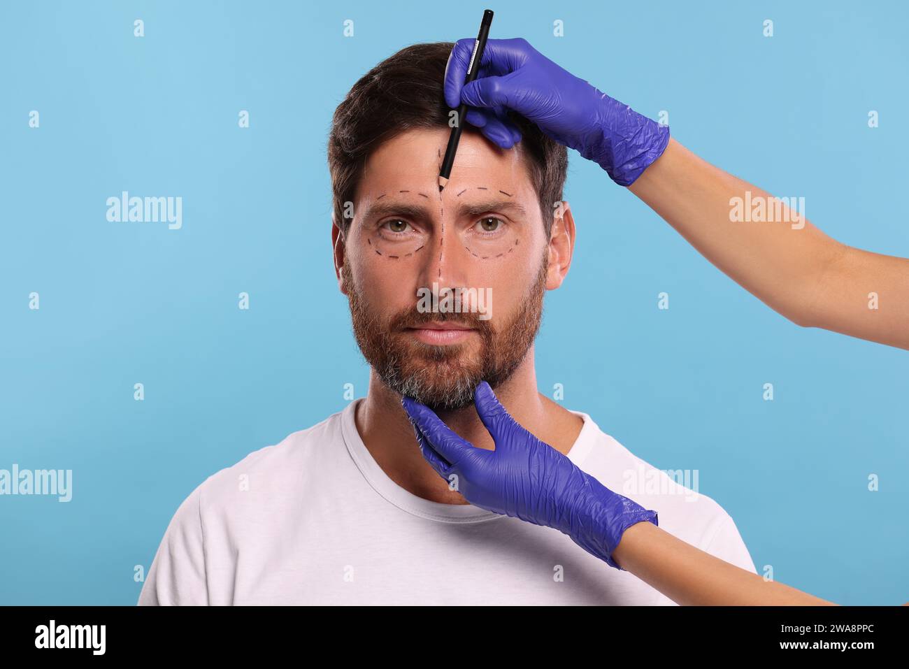 Doctor drawing marks on man's face for cosmetic surgery operation ...