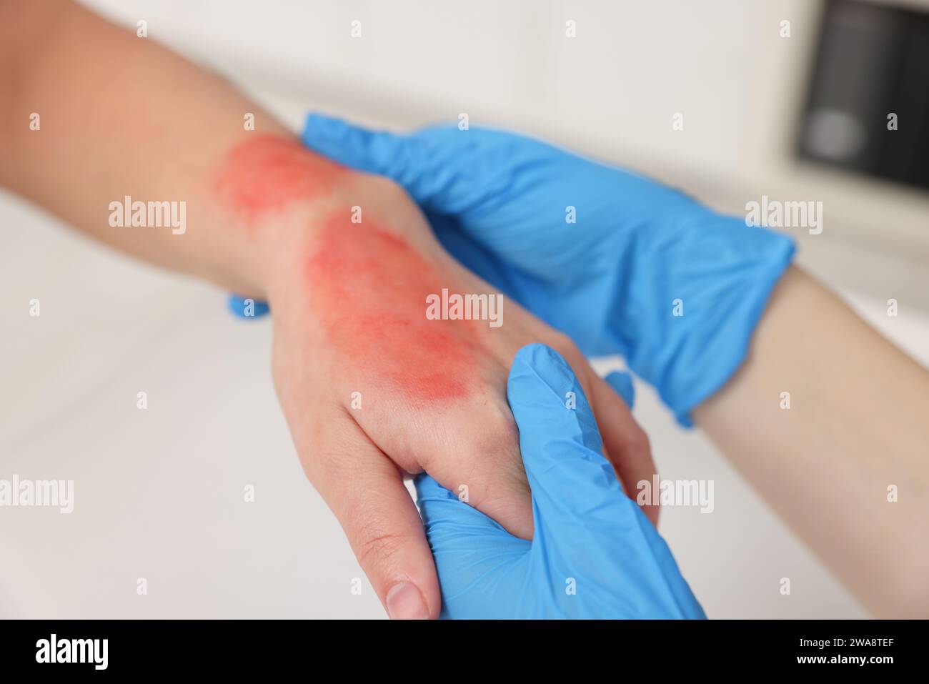 Thermal burn skin hi-res stock photography and images - Alamy