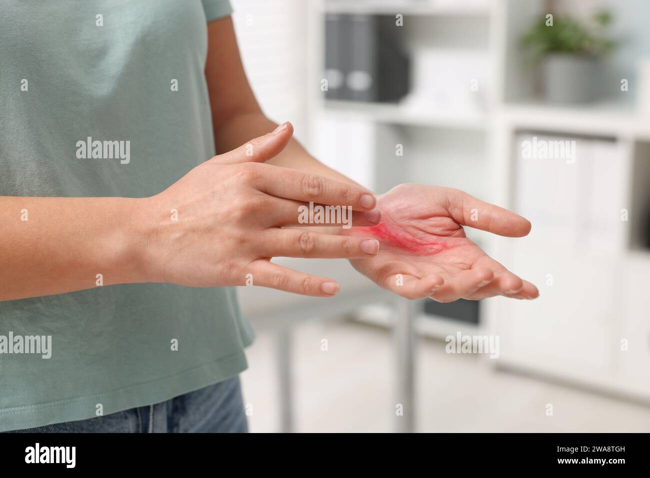 Thermal burn skin hi-res stock photography and images - Alamy