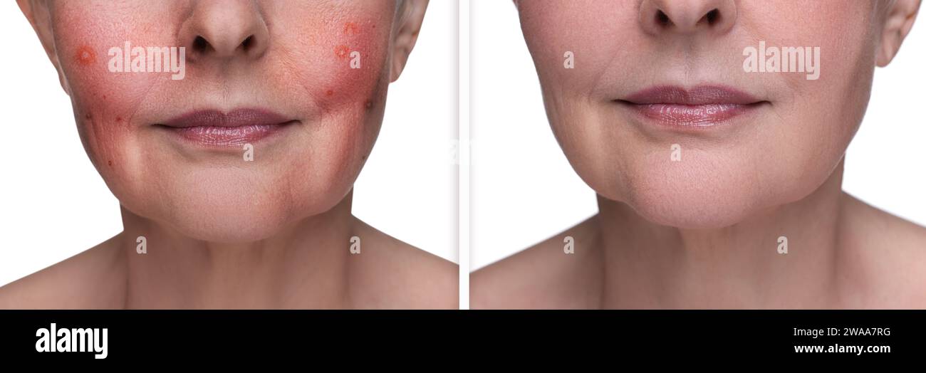 Before and after rosacea treatment. Photos of woman on white background ...