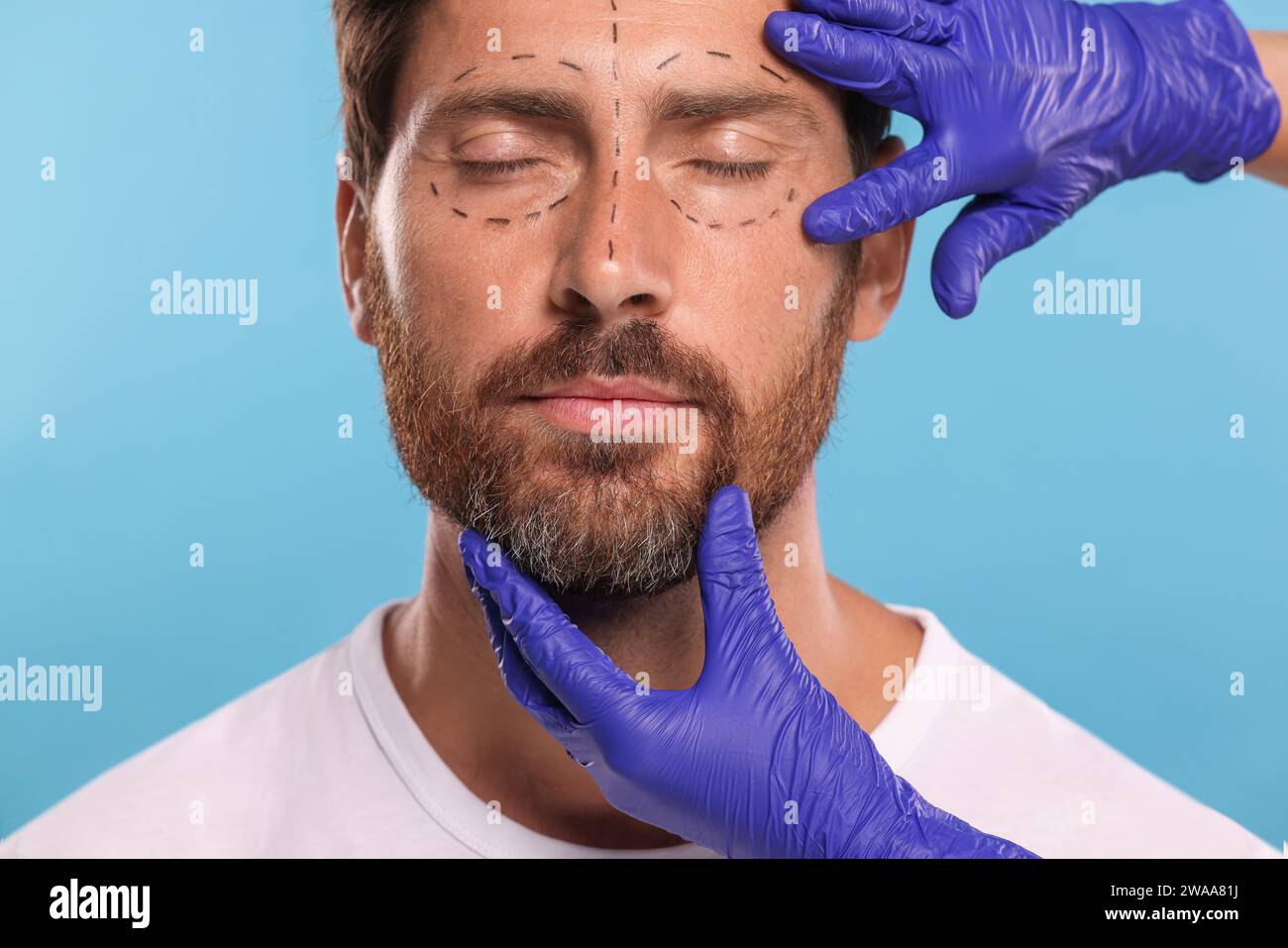 Doctor checking marks on man's face for cosmetic surgery operation ...