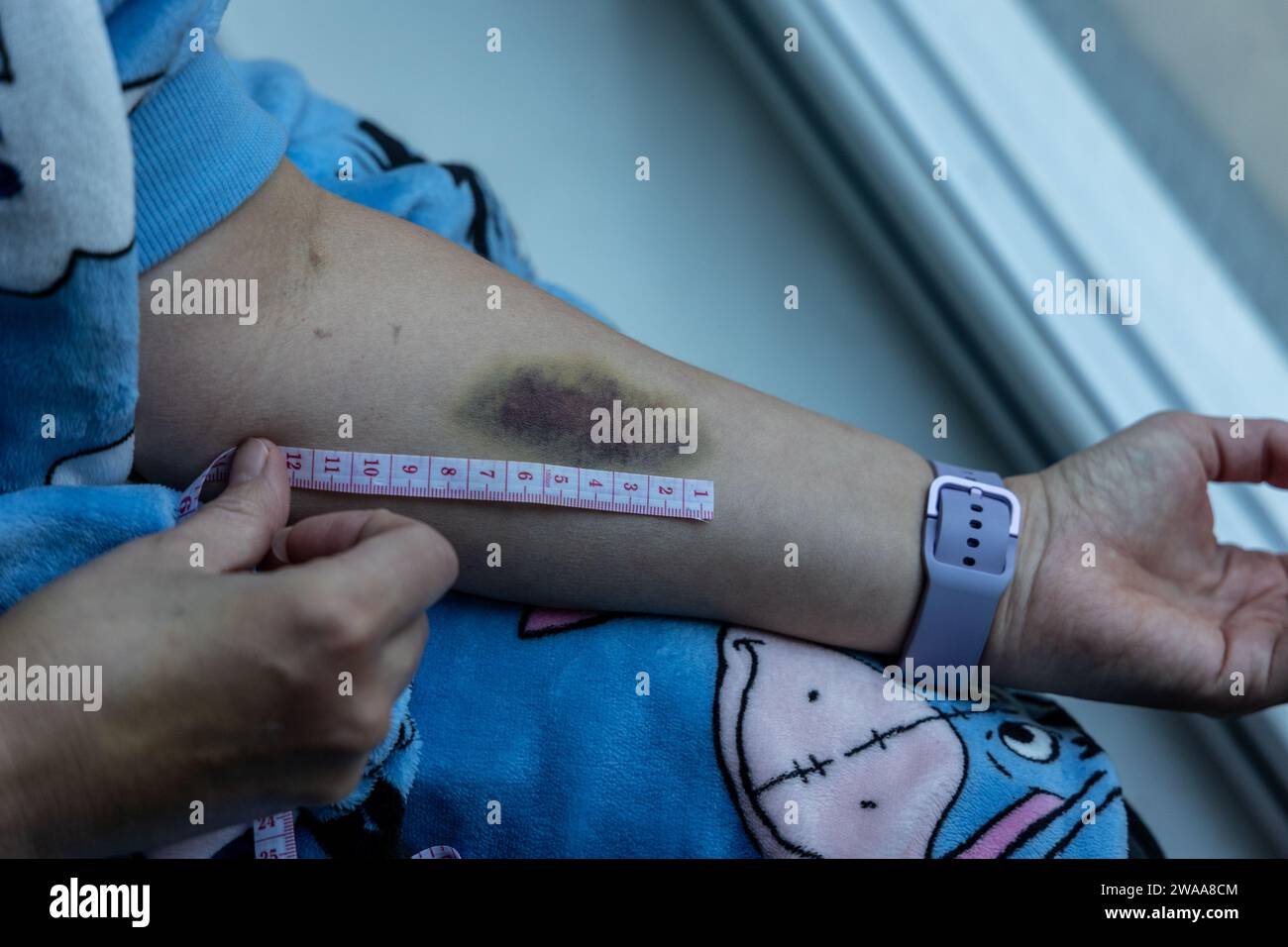 Bruising from cannula in forearm Stock Photo - Alamy