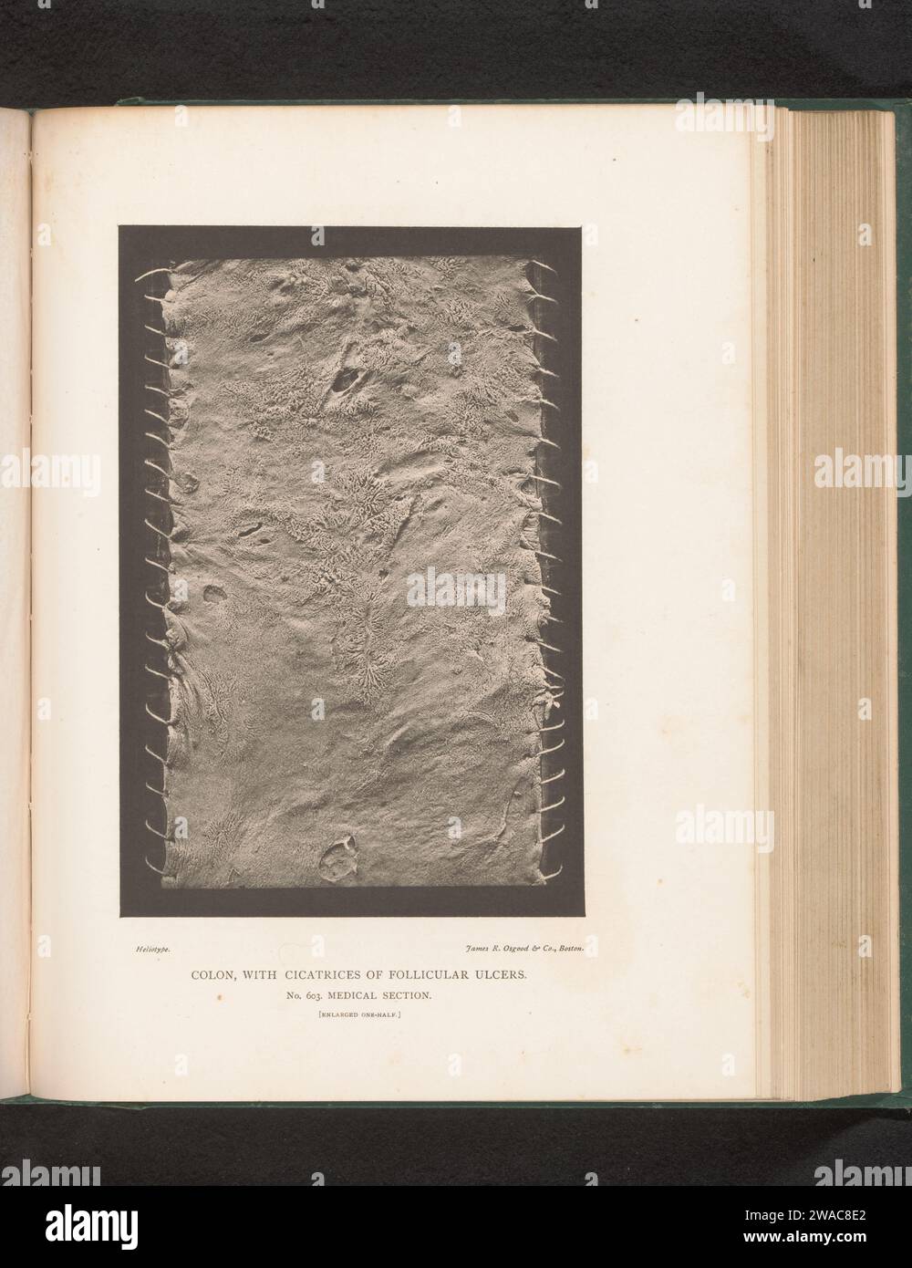 Tiled piece of large intestine with scar tissue of swollen cavities, E ...