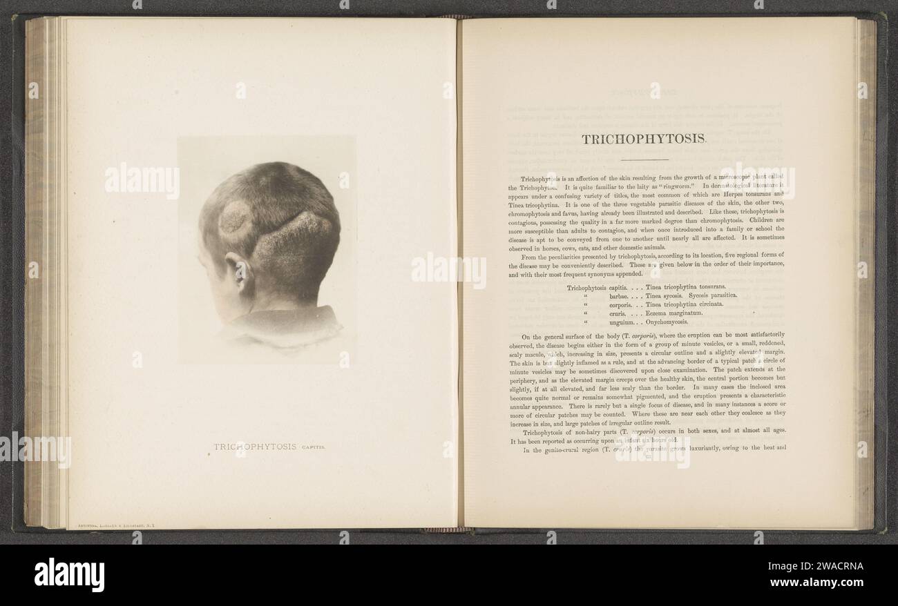 Patient suffering from the skin disease 'trichophytosis capitis', c ...