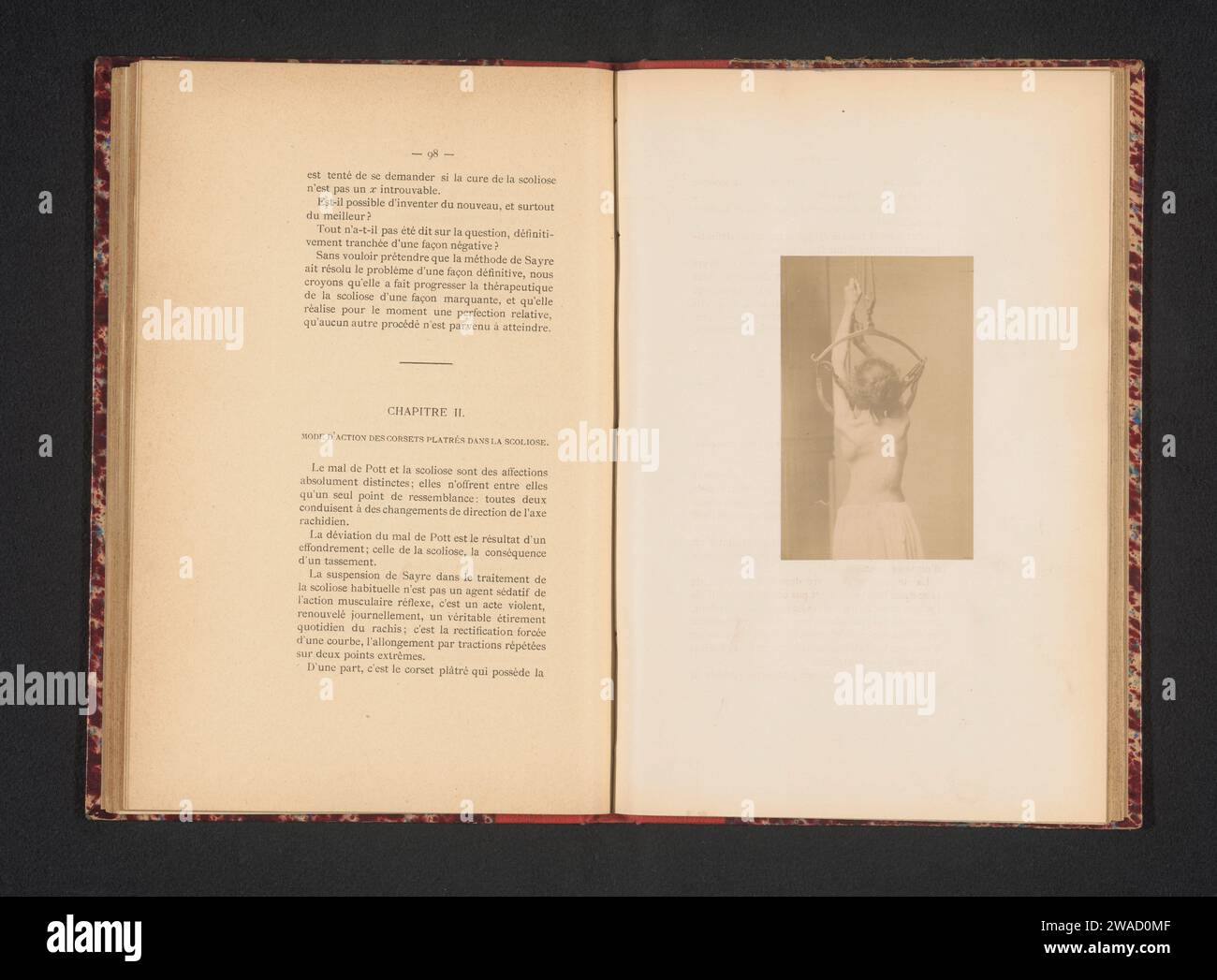 Girl undergoes treatment for problems with her backbone, anonymous, c ...