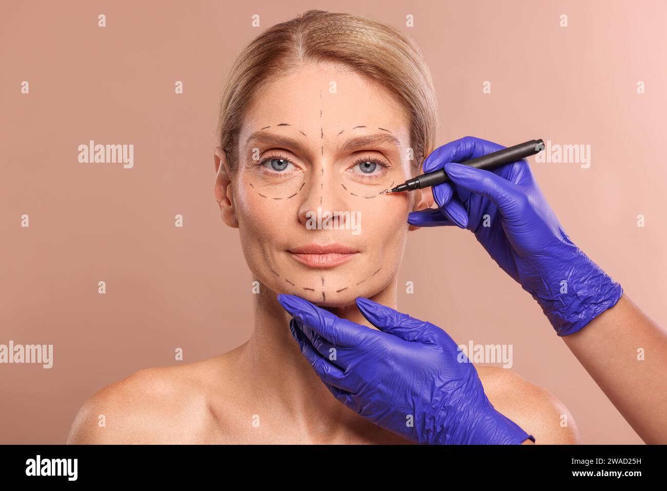 Doctor with marker preparing patient for cosmetic surgery operation on ...