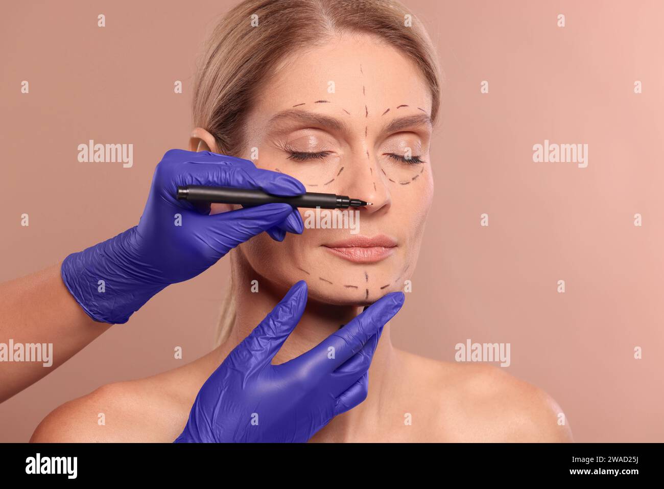 Doctor with marker preparing patient for cosmetic surgery operation on ...