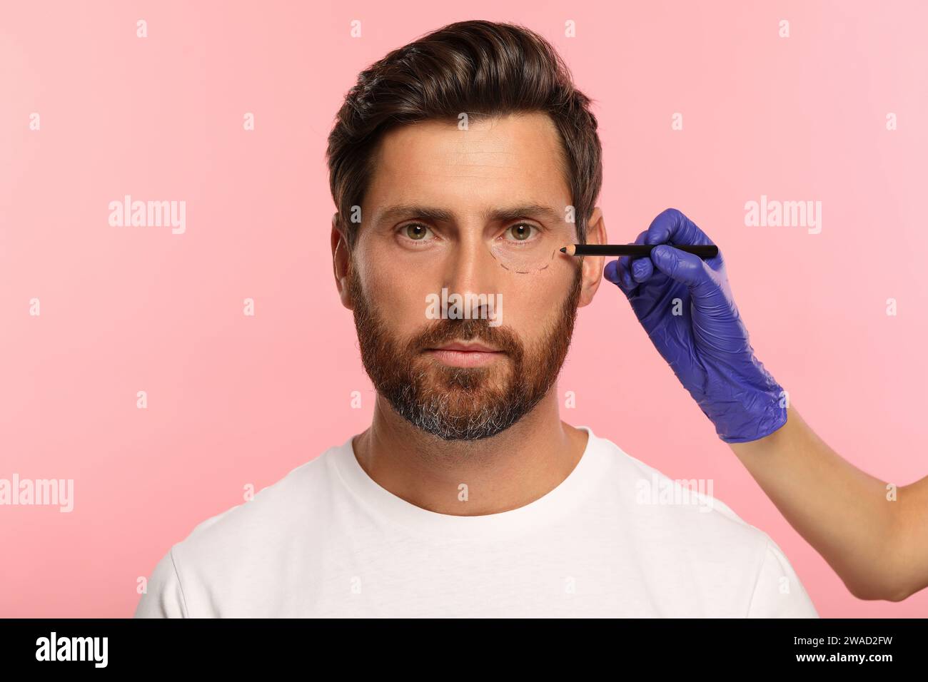 Doctor with pencil preparing patient for cosmetic surgery operation on ...