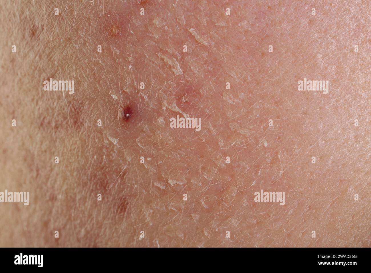Texture of skin with acne problem as background, macro view Stock Photo ...
