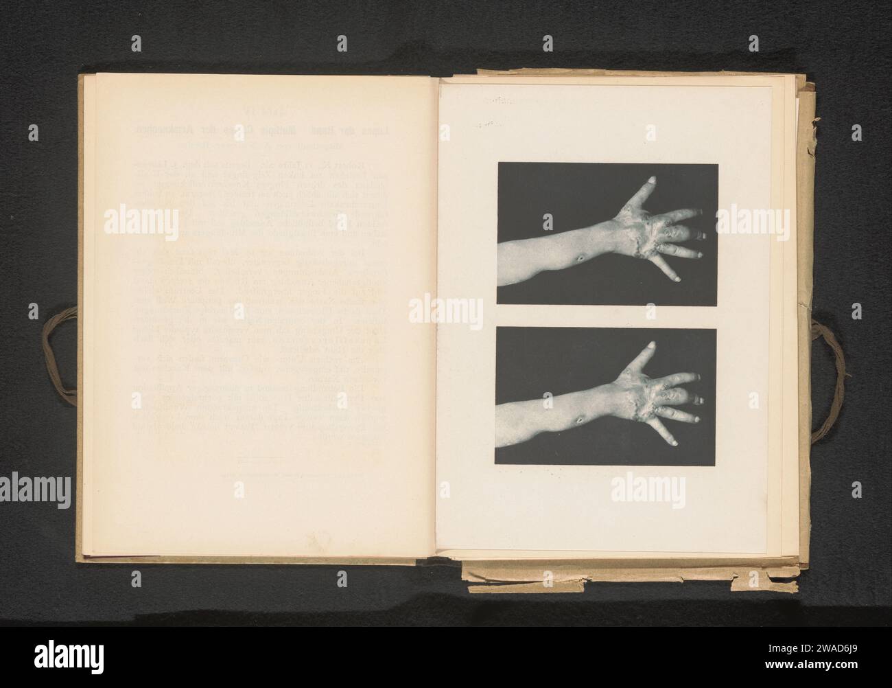 Two looks of an arm with symptoms of skin lupus, Albert Ludwig ...