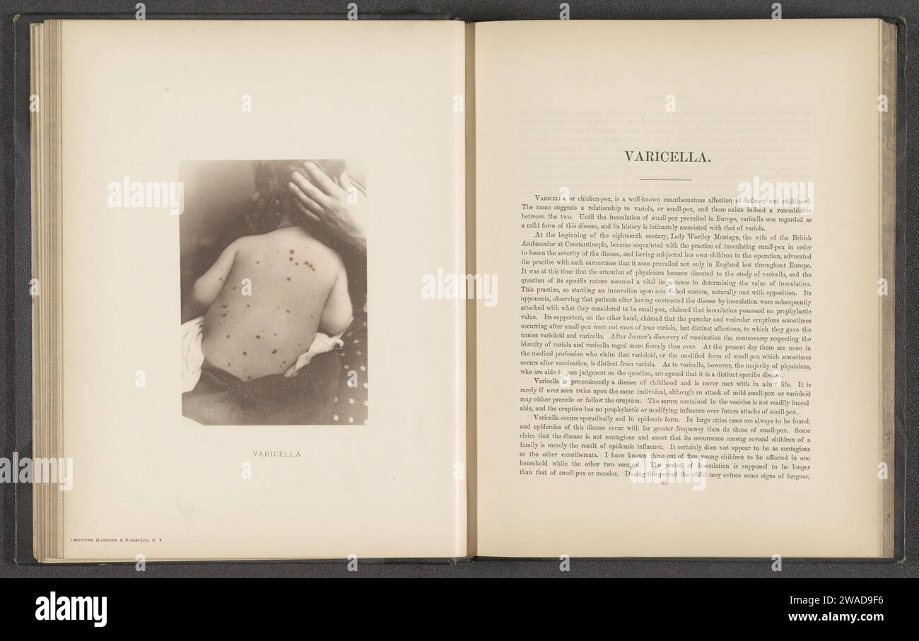 Patient suffering from the skin disease 'varicella', c. 1870 - in Or ...