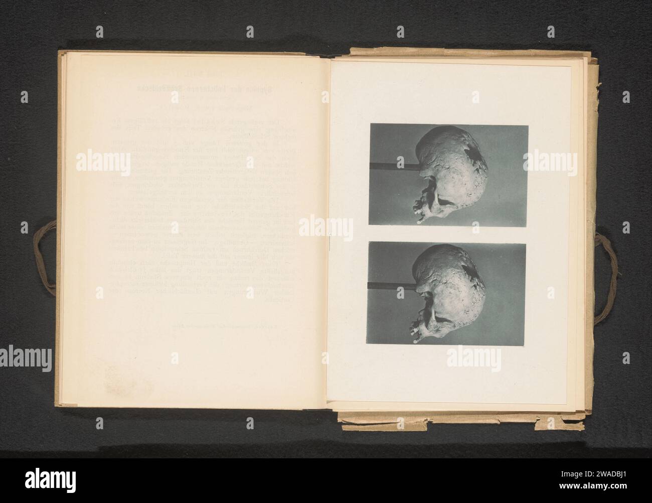 Two looks of a skull with the consequences of syphilis on the skull ...