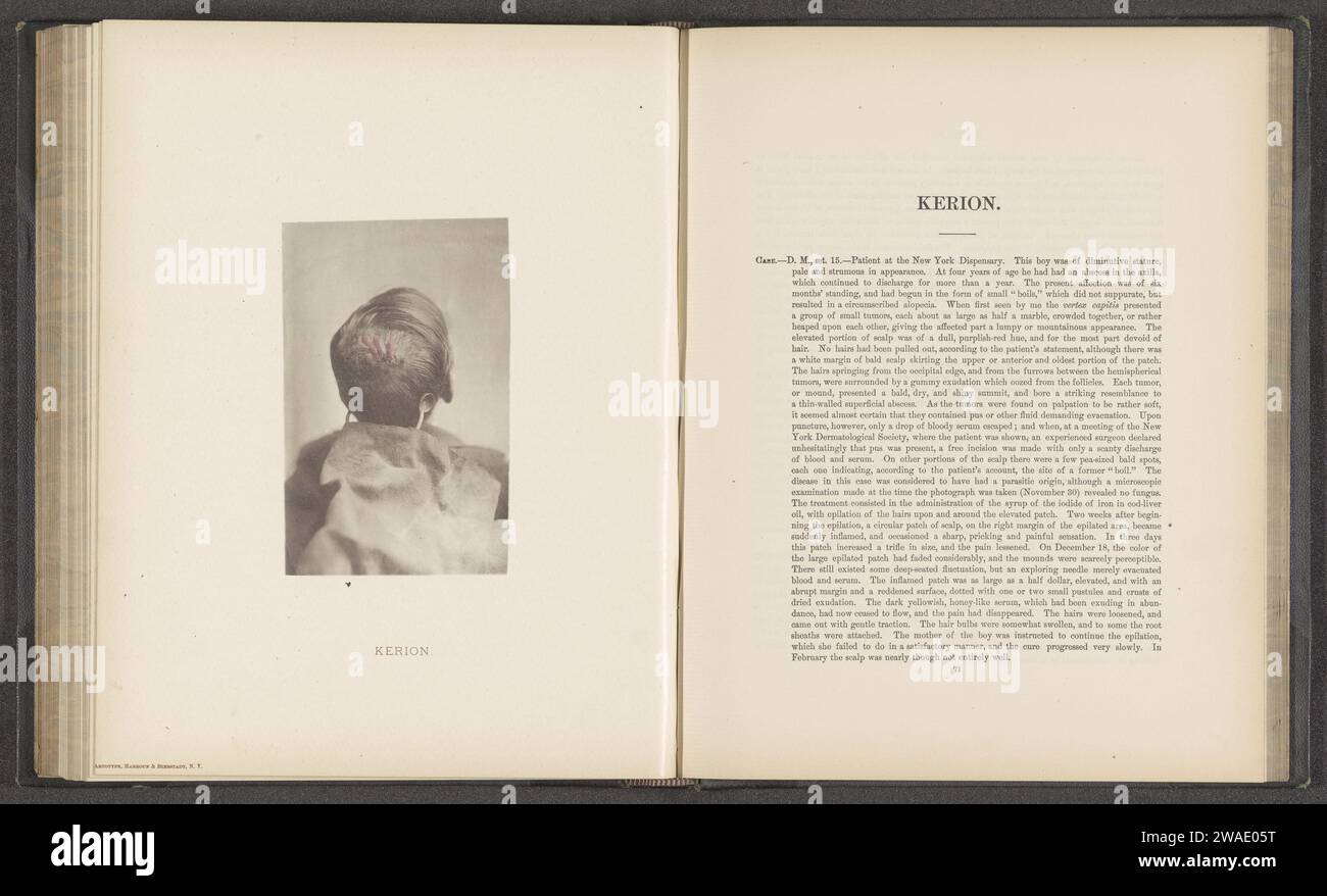 Kerion hi-res stock photography and images - Alamy