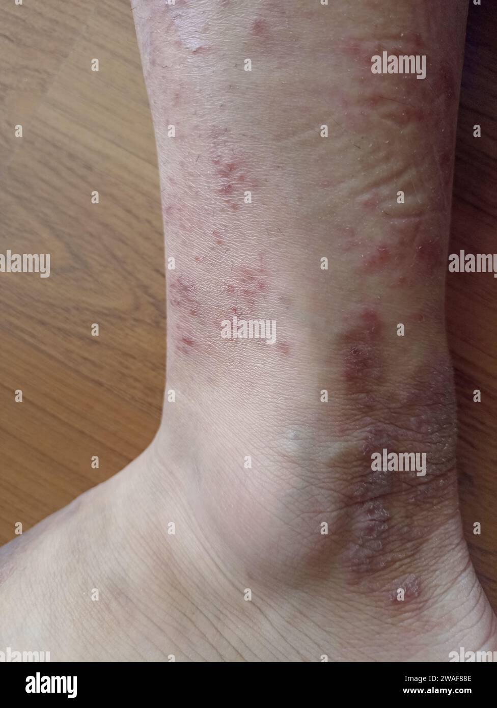 rash eczema dermatitis on leg. inflammation of skin Stock Photo - Alamy