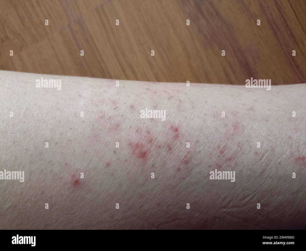 rash eczema dermatitis on leg. inflammation of skin Stock Photo - Alamy
