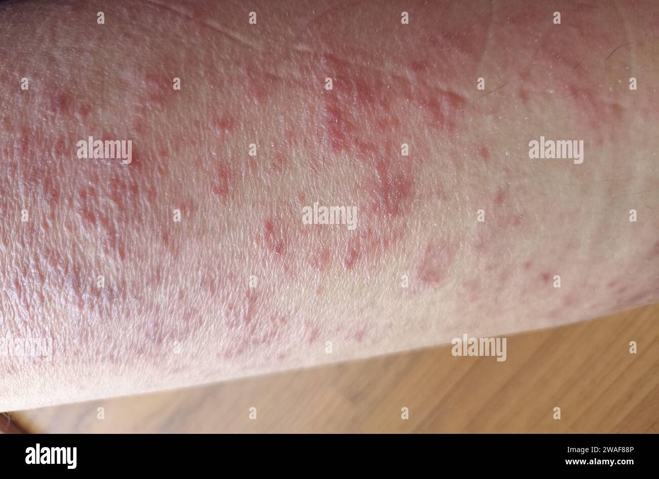 rash eczema dermatitis on leg. inflammation of skin Stock Photo - Alamy