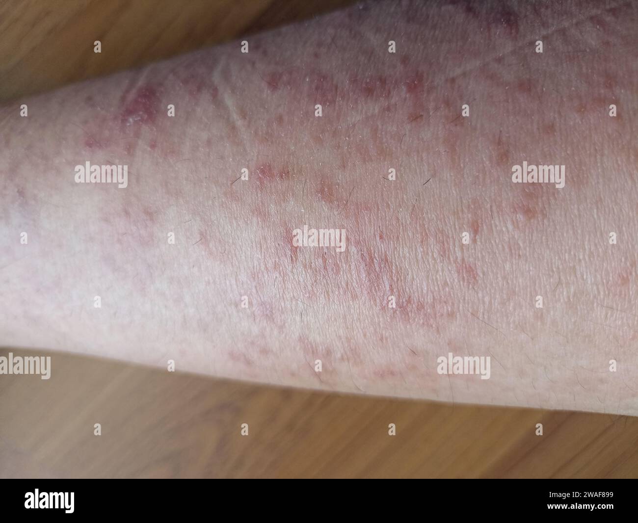 rash eczema dermatitis on leg. inflammation of skin Stock Photo - Alamy