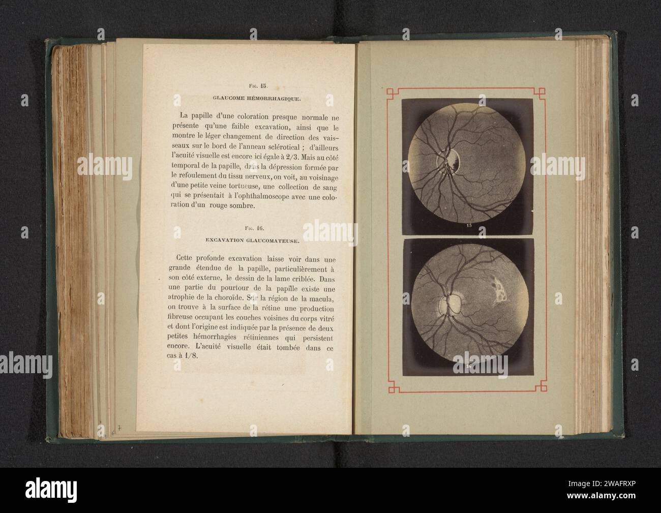 Anatomical distortion hi-res stock photography and images - Alamy