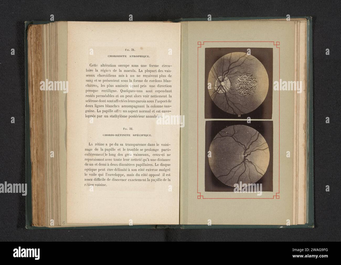 Photo production of two anatomical drawings of an inflammation of the ...