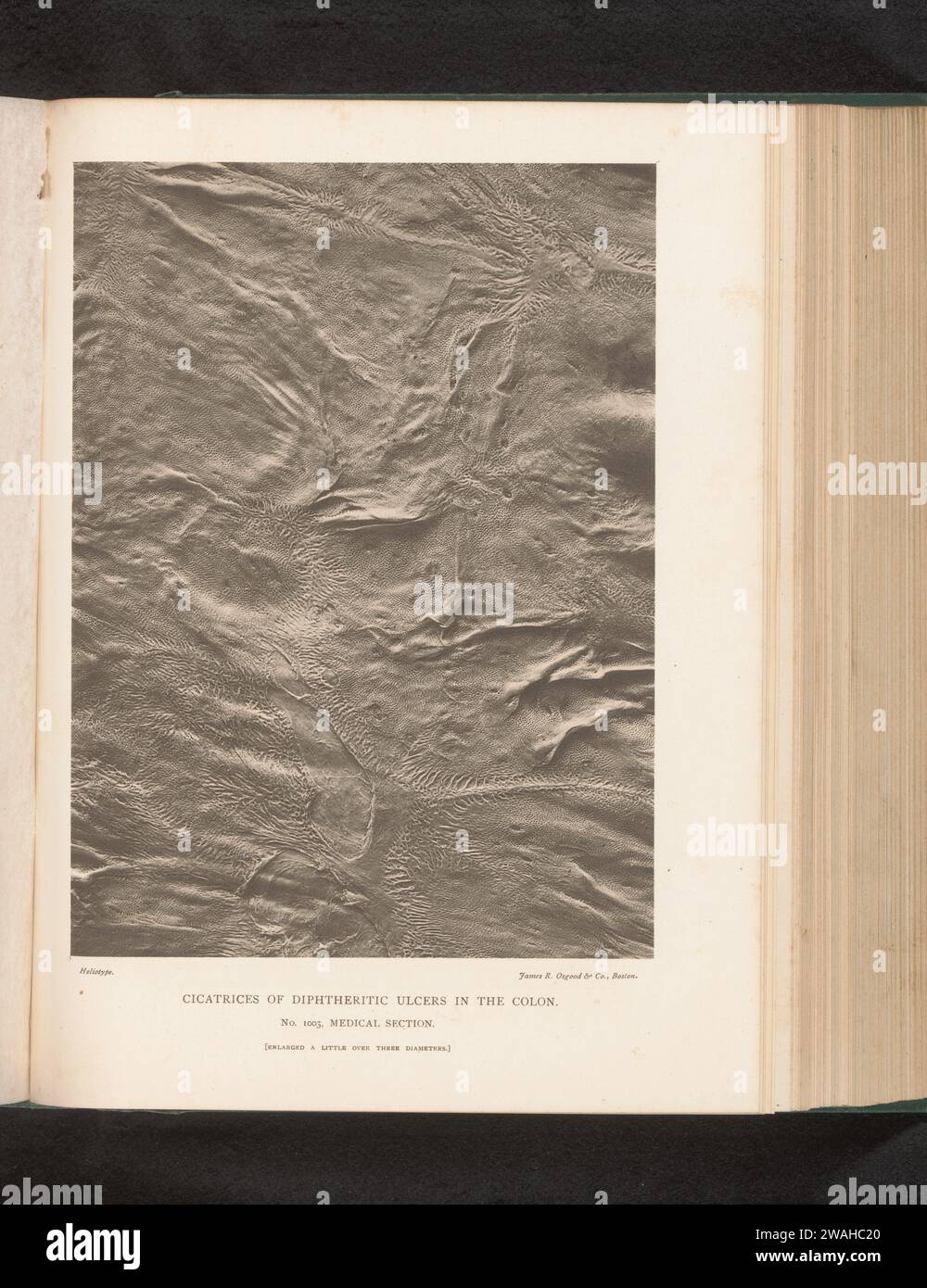 Increasing a piece of large intestine with scar tissue of swears by ...