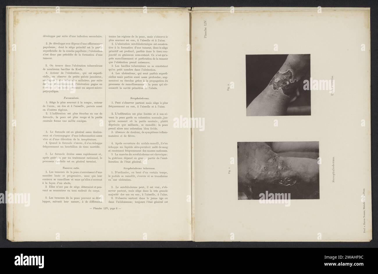 Ulcus cruris hi-res stock photography and images - Alamy