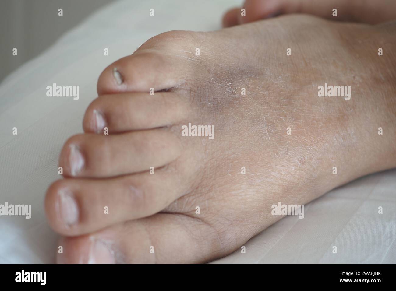 close up of women feet with swelling Stock Photo - Alamy