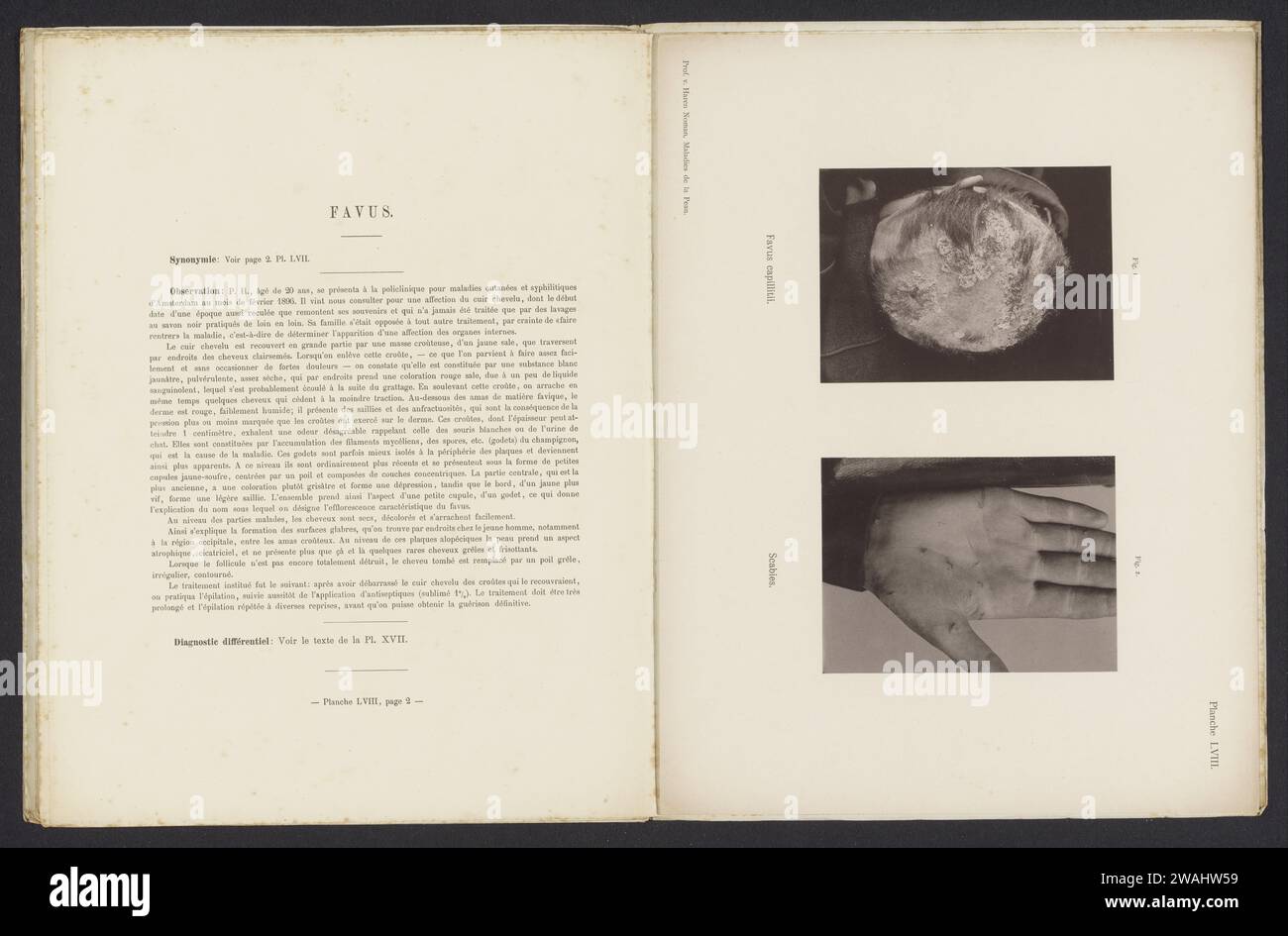 Patients suffering from the skin disease 'Favus Capillitii' and ...