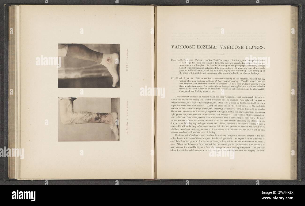 Varicosis hi-res stock photography and images - Alamy