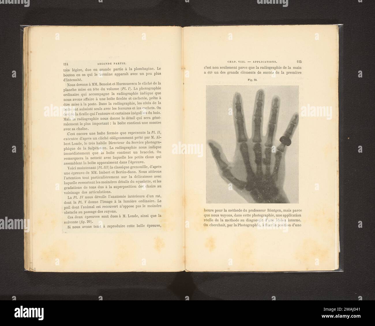 Hand x ray ring hi-res stock photography and images - Alamy