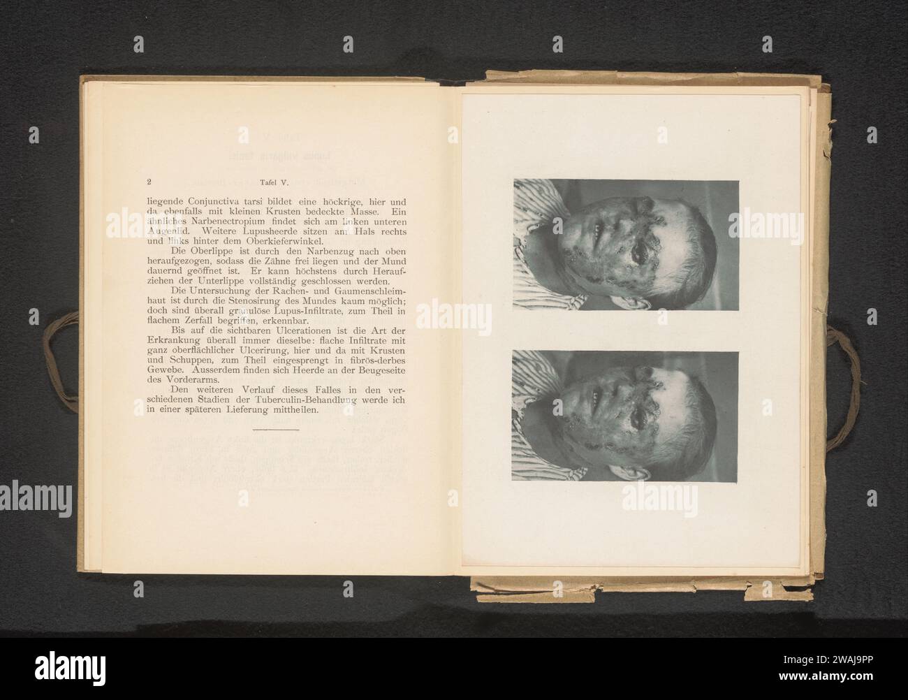 Two portraits of a patient with symptoms of skin tuberculosis on the ...