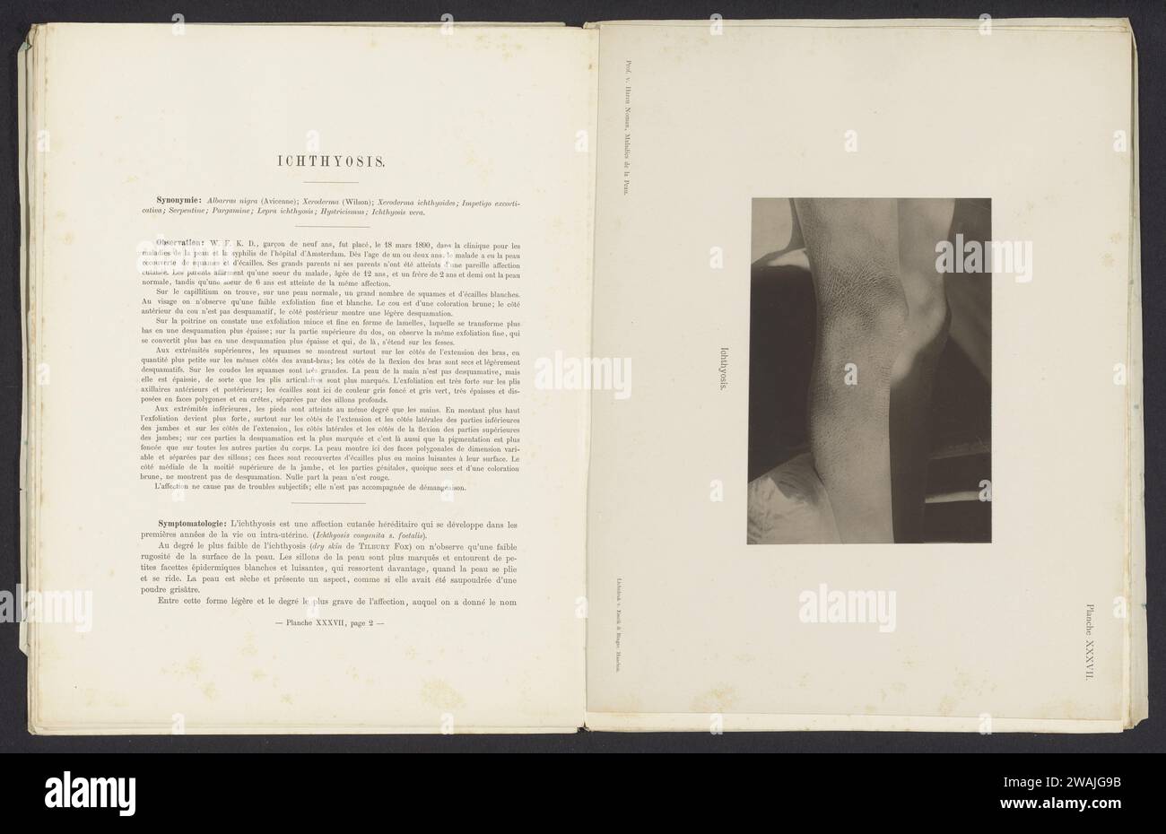 Ichthyosis genetic skin disorders hi-res stock photography and images ...