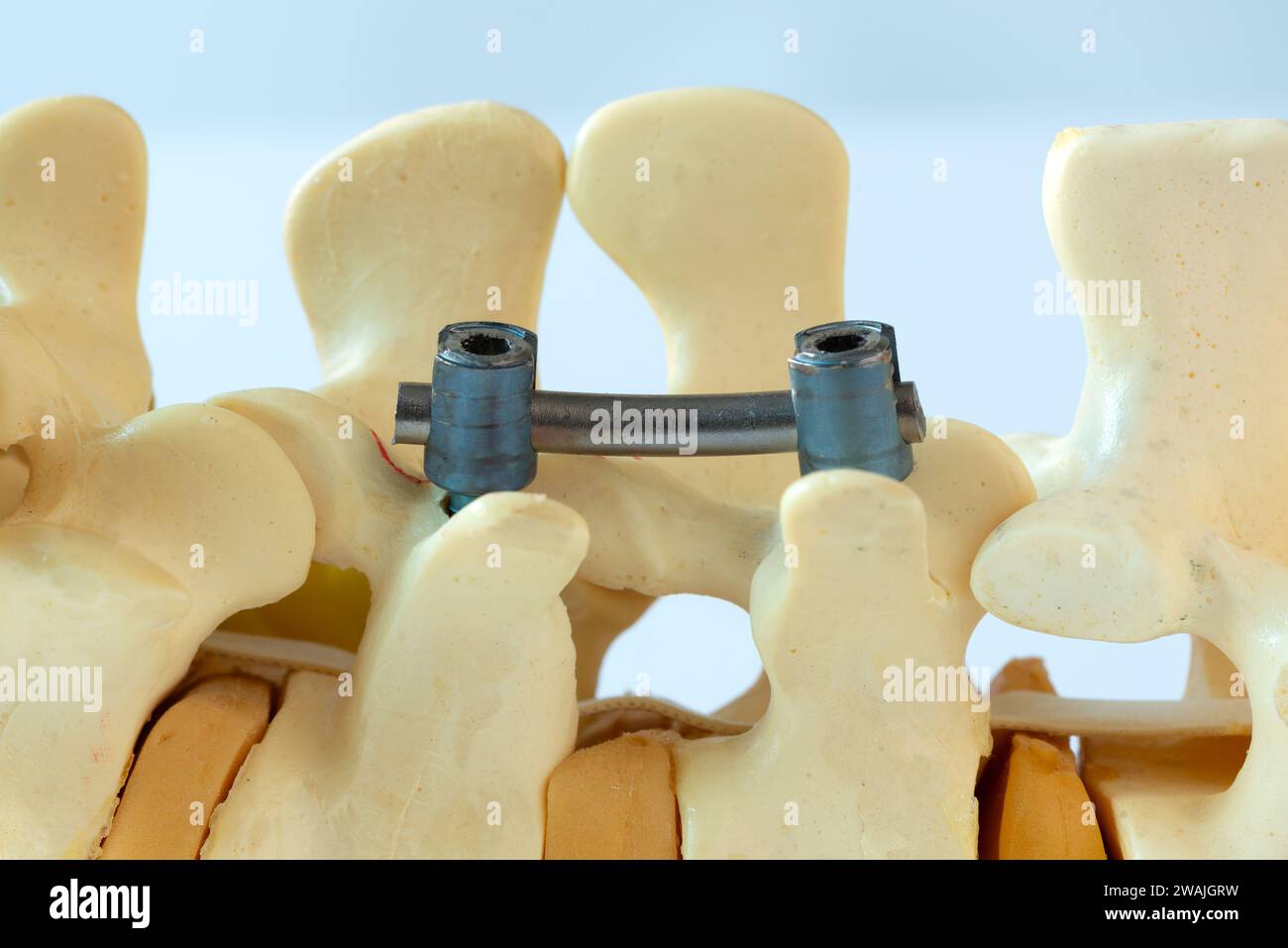 Lumbar spine operation hi-res stock photography and images - Alamy