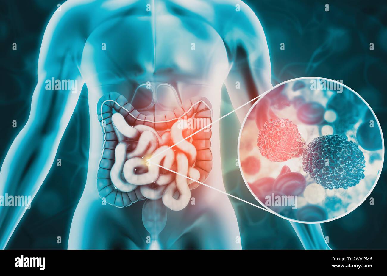 Human body anatomy. Colon cancer, Colon disease concept, 3d ...