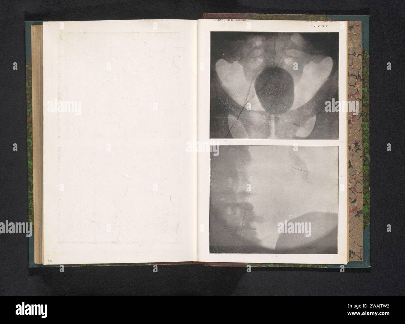 X -ray of a pelvis, anonymous, c. 1904 - in or before 1909 ...