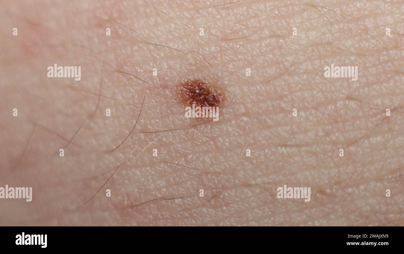 Birthmark hi-res stock photography and images - Alamy
