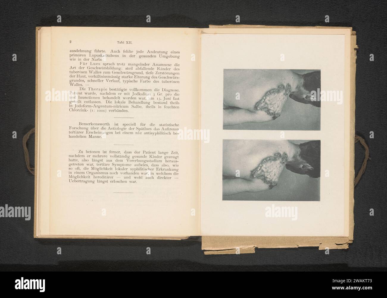 Syphilis ulcer hi-res stock photography and images - Alamy