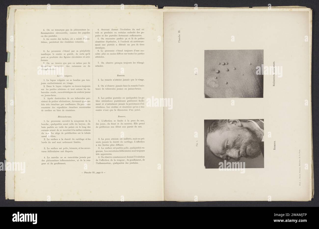 Molluscum sebaceum hi-res stock photography and images - Alamy