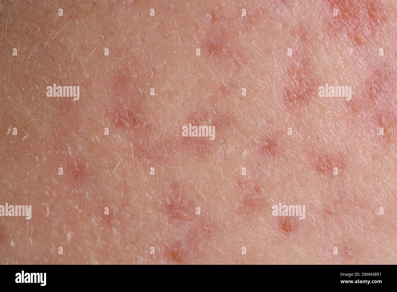 Texture of skin with acne problem as background, macro view Stock Photo ...