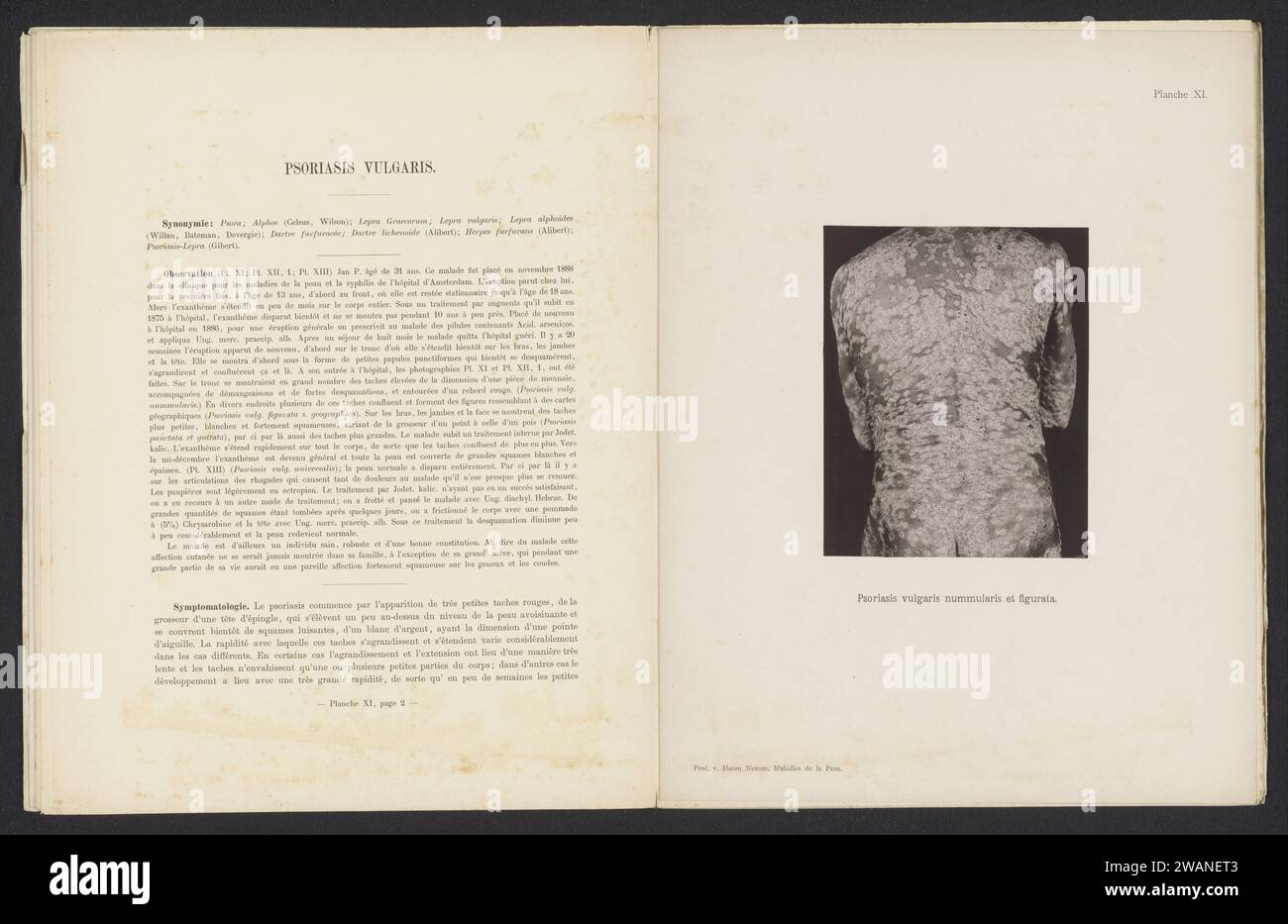 Patient suffering from the skin disease 'Psoriasis vulgaris ...