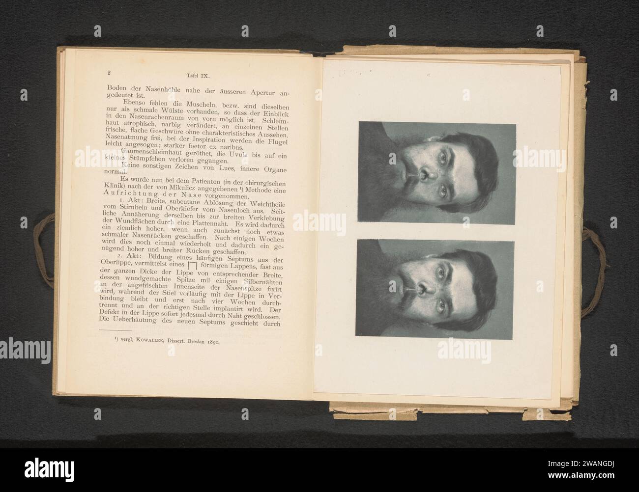 Two portraits of a man with a saddle nose due to a missing nasal seal ...