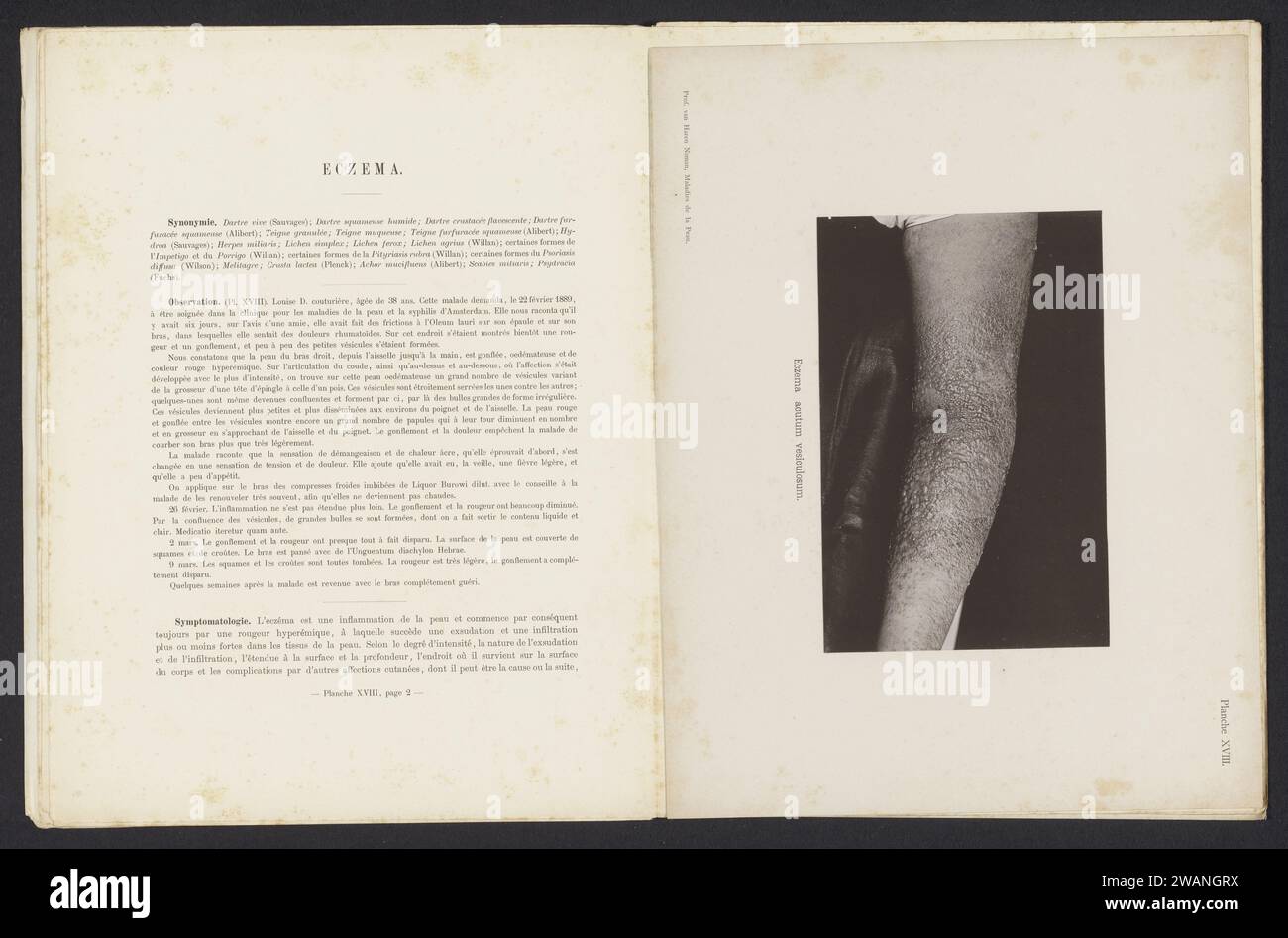 Patient suffering from the skin disease 'Eczema acutum vesiculosum', c ...