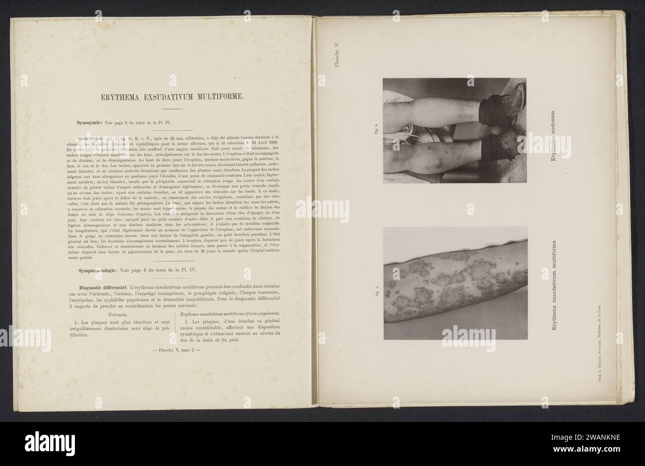 Patients suffering from the skin disease 'Erythema exudativum ...