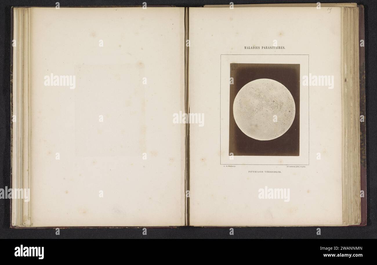Microscope intake of the Pityriasis Versicolor disease, A. de Montméja ...