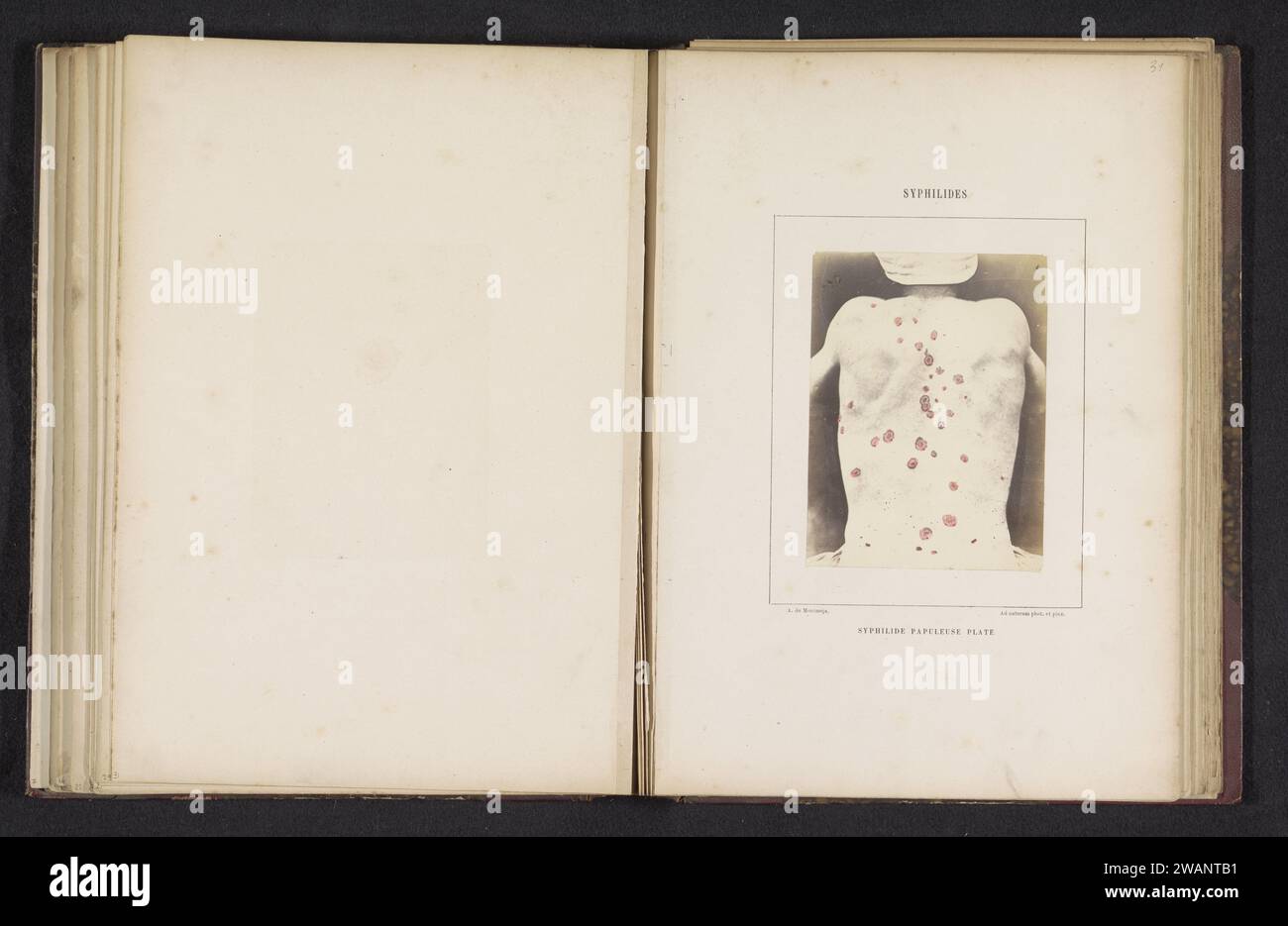 Syphilis rash hi-res stock photography and images - Alamy